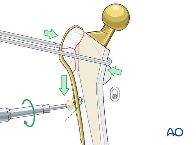 Compression plate and screw fixation for Trochanteric femoral fracture