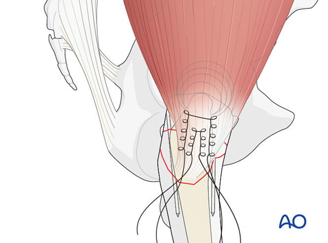 Compression plate and screw fixation for Trochanteric femoral fracture