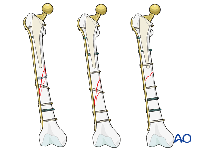 Compression plate and screw fixation for Fracture of the femur distant ...