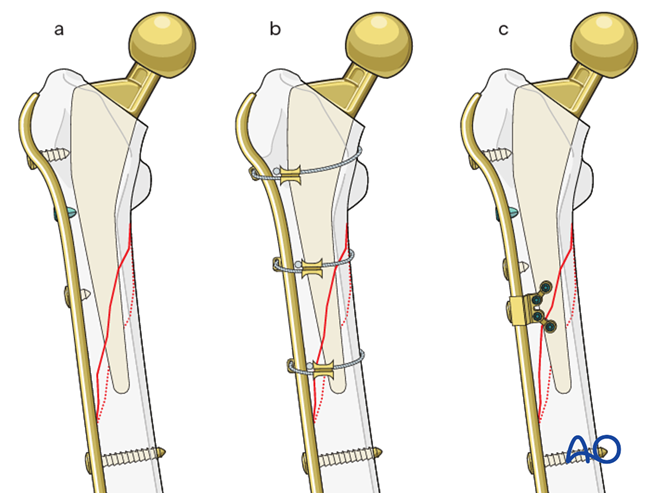 Revision arthroplasty with ORIF for Fracture around the stem with an ...