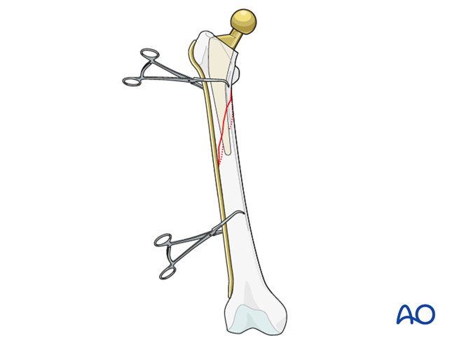 Compression plate and screw fixation for Fracture around the stem with ...