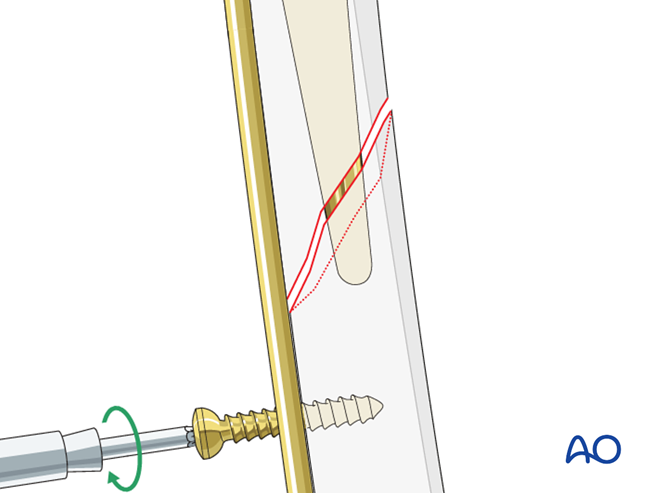 Compression plate and screw fixation for Fracture around the stem with ...