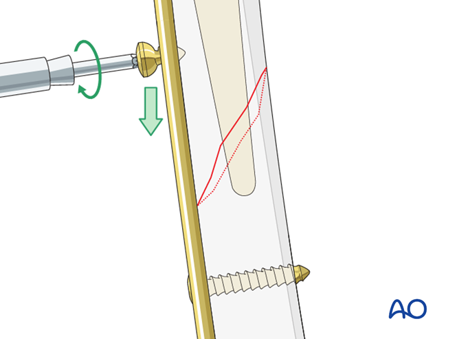 Compression plate and screw fixation for Fracture around the stem with ...