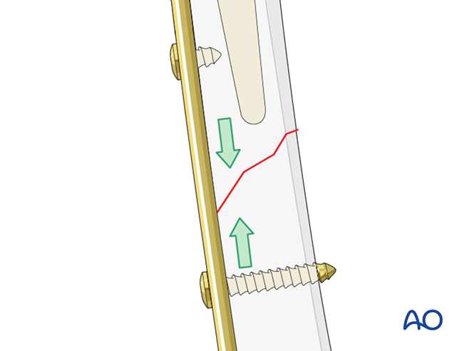 Compression plate and screw fixation for Fracture of the femur distant ...