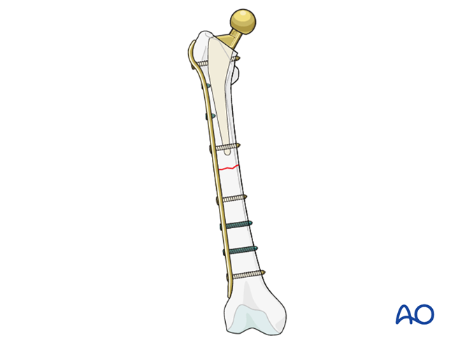 Compression plate and screw fixation for Fracture of the femur distant ...