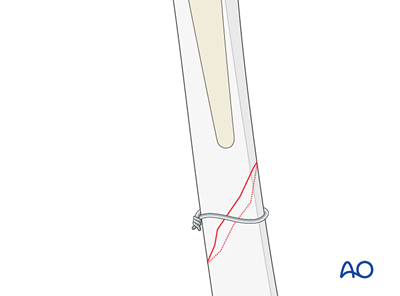 Compression plate and screw fixation for Fracture of the femur distant ...