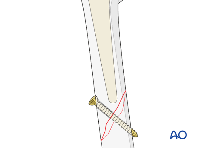 Compression plate and screw fixation for Fracture of the femur distant ...