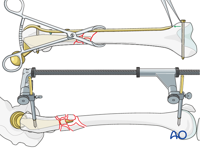 Intramedullary nail and plate fixation for Fracture of the femur ...