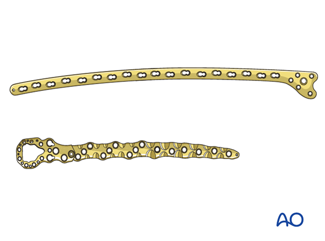Bridge plate and screw fixation for Fracture around the stem with a ...