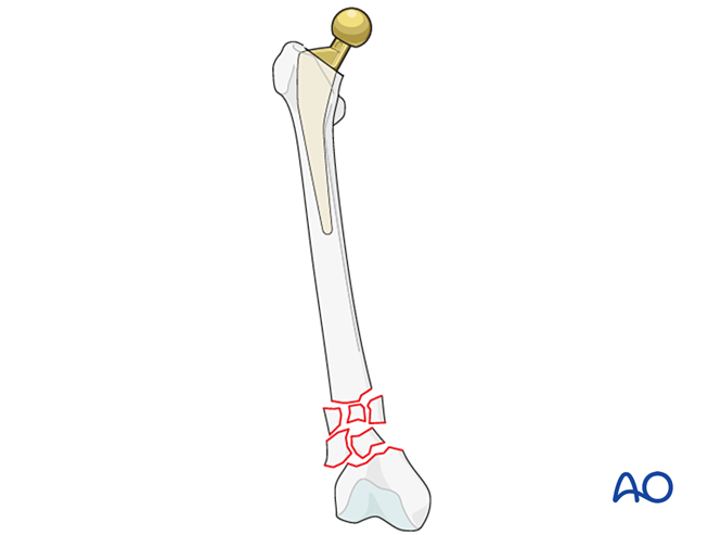 Intramedullary nail and plate fixation for Fracture of the femur ...