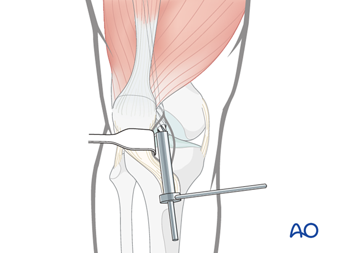 Intramedullary nail and plate fixation for Fracture of the femur ...