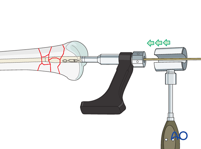 Intramedullary nail and plate fixation for Fracture of the femur ...