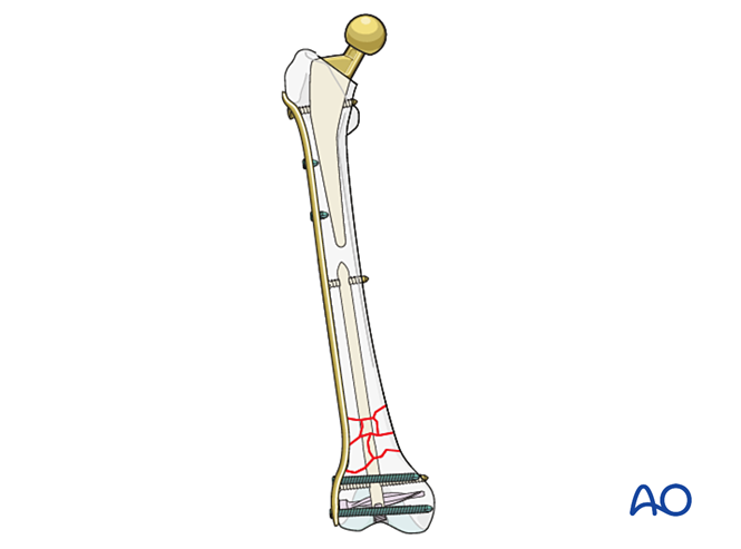 Intramedullary nail and plate fixation for Fracture of the femur ...