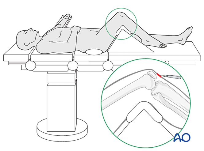 Intramedullary nail and plate fixation for Fracture of the femur ...