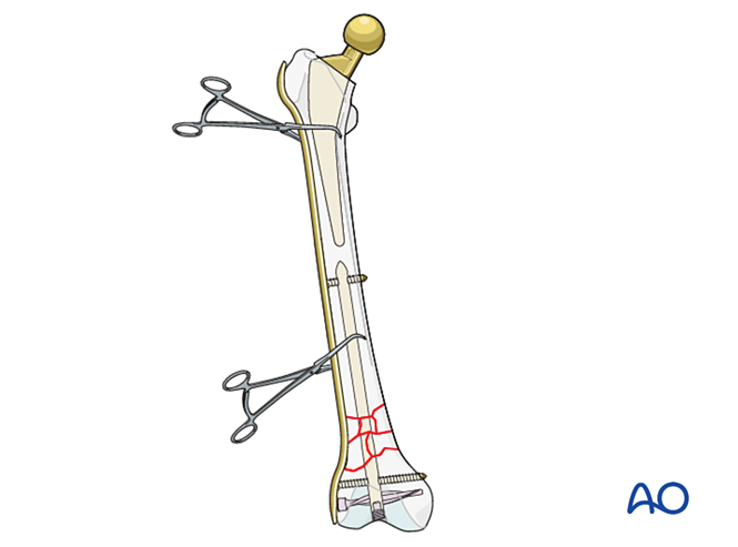 Intramedullary nail and plate fixation for Fracture of the femur ...