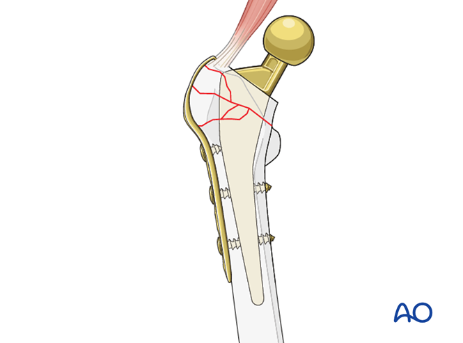 Hook plate and screw fixation for Fracture around the stem with a ...