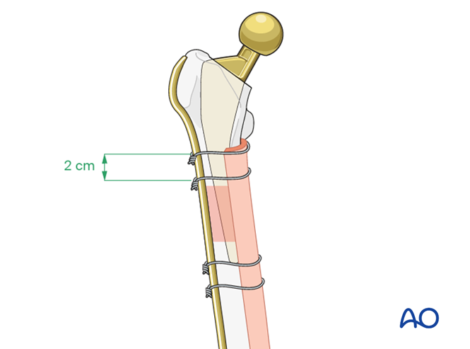 Structural allograft and cerclage