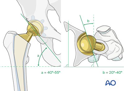 Constrained cup implantation