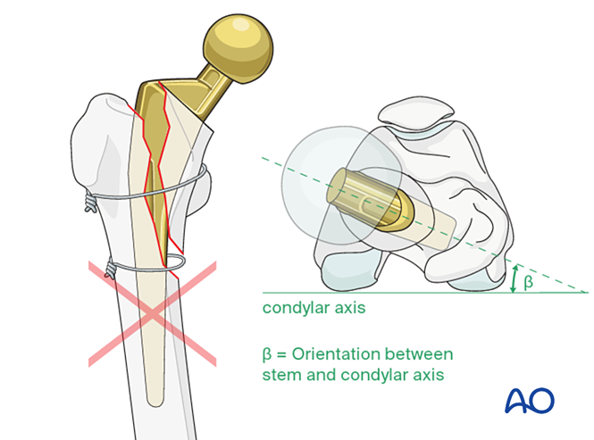 Diaphyseal fixation using long cylindrical stem for Trochanteric ...