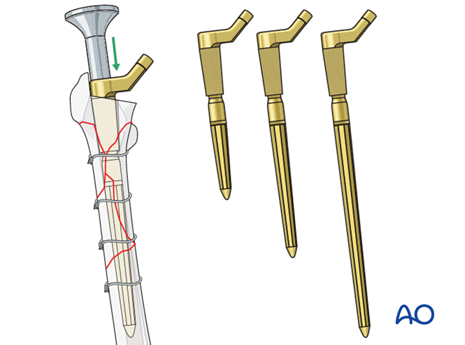 Diaphyseal fixation using long tapered stem for Fracture around the ...