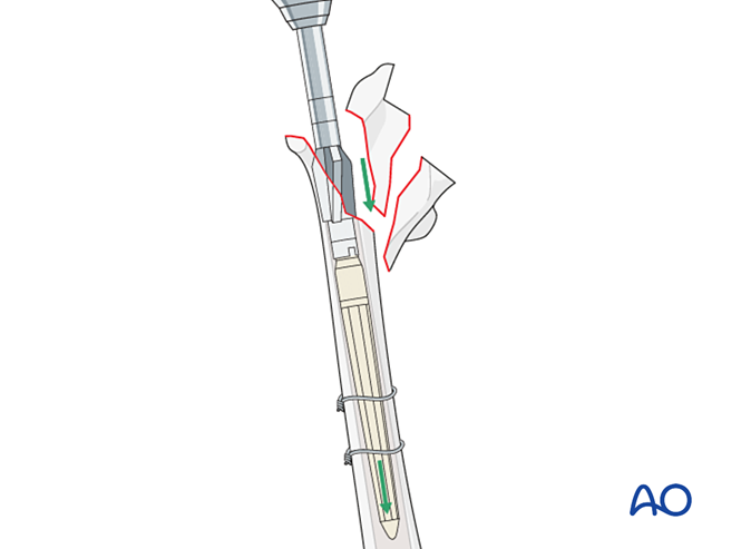 Diaphyseal fixation using long tapered stem for Trochanteric femoral ...