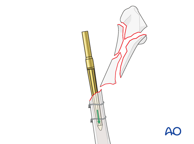 Diaphyseal fixation using long tapered stem for Fracture around the ...