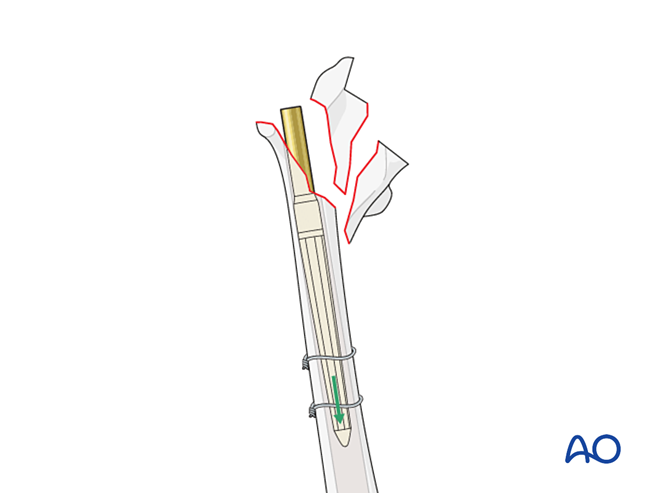 Diaphyseal fixation using long tapered stem for Trochanteric femoral ...