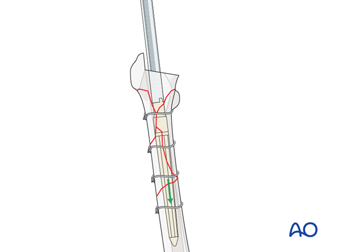 Diaphyseal fixation using long tapered stem for Fracture around the ...