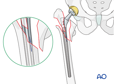 Diaphyseal fixation using long tapered stem for Trochanteric femoral ...