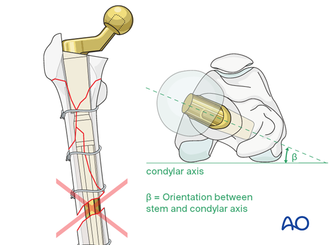 Diaphyseal fixation using long tapered stem for Fracture around the ...