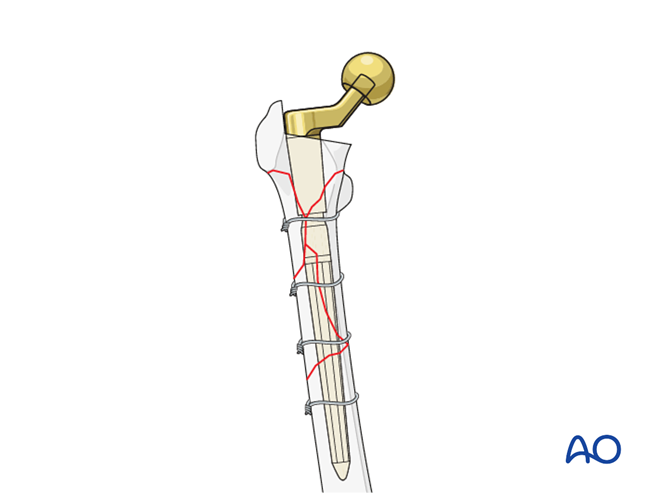 Revision arthroplasty with ORIF for Fracture around the stem with an ...