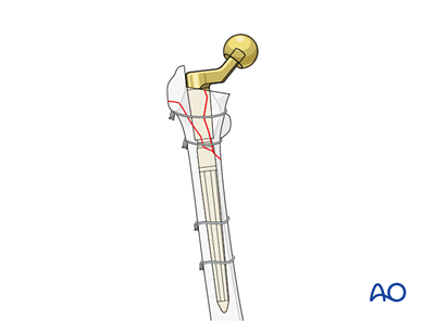 Revision arthroplasty with ORIF for Trochanteric femoral fracture