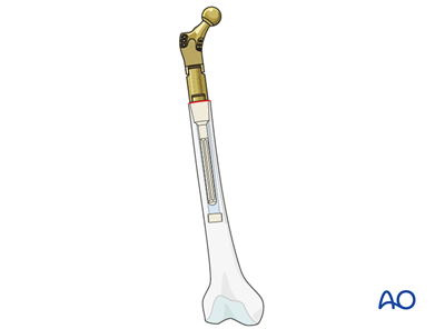 Proximal femoral replacement for Fracture around the stem with an ...