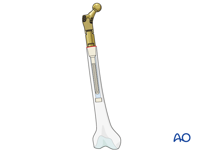 Revision arthroplasty with ORIF for Fracture around the stem with an ...