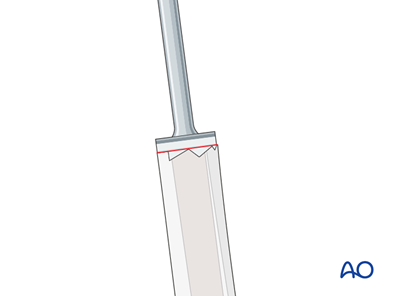 Proximal femoral replacement for Fracture around the stem with an ...