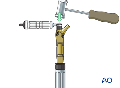 Proximal femoral replacement for Fracture around the stem with an ...