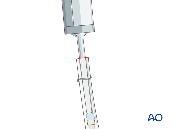 Proximal femoral replacement for Fracture around the stem with an ...