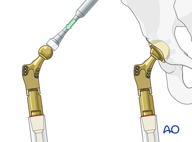 Proximal femoral replacement for Fracture around the stem with an ...