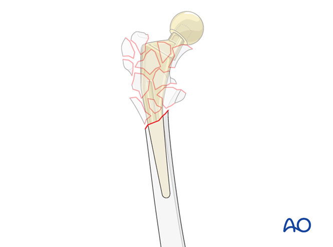 Proximal femoral replacement for Fracture around the stem with an ...