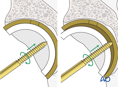 Constrained cup implantation