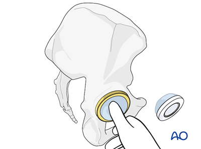 Polyethylene liner revision