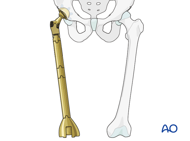 Total femur replacement for Fracture around a loose femoral component ...