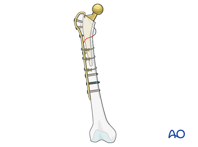 Revision arthroplasty with ORIF for Fracture around the stem with an ...