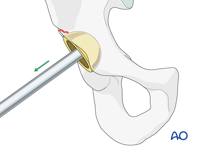 Revision of cup to multihole pressfit cup for Intraoperative acetabular ...