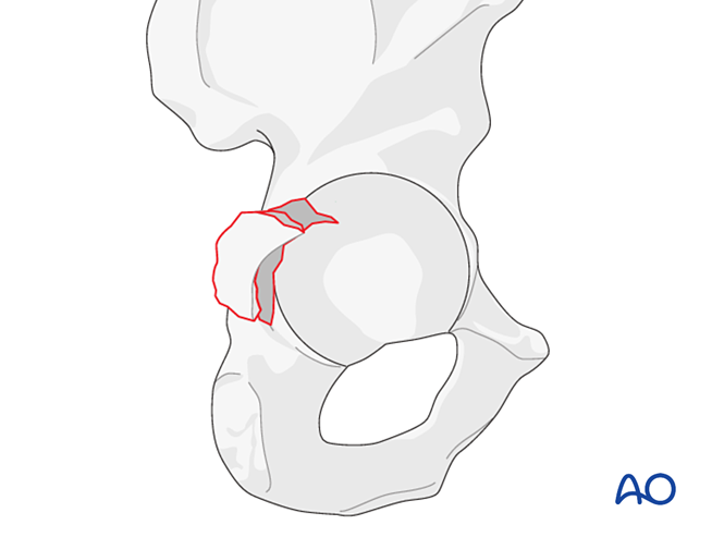 ORIF of posterior moiety fractures for Intraoperative fracture during ...