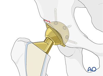 ORIF of protrusio fractures for Intraoperative acetabular fracture ...