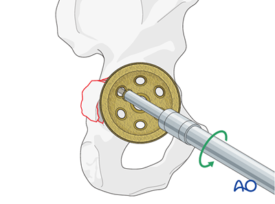 Revision of cup to antiprotrusio cage for Spontaneous acetabular fracture