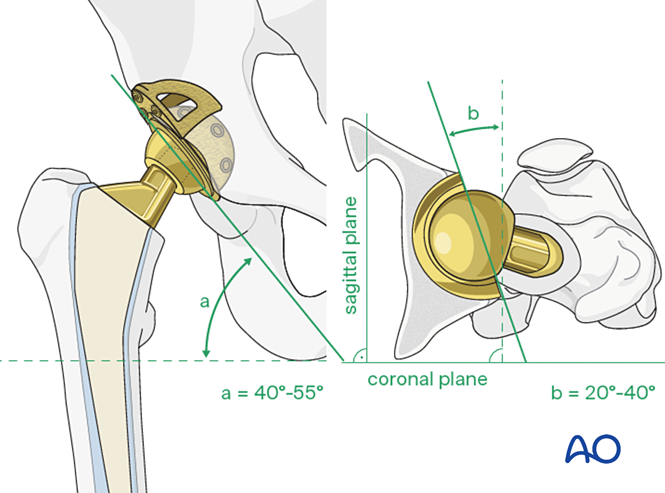Revision of cup to multihole pressfit cup with augments for Spontaneous ...