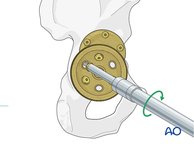 Revision of cup to multihole pressfit cup with augments for ...