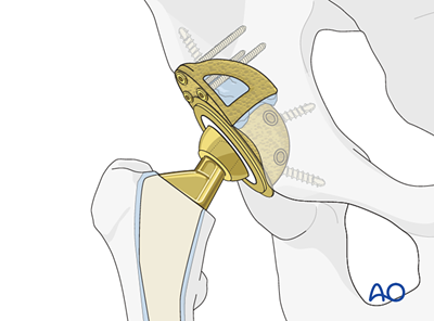 Revision of cup to multihole pressfit cup with augments for Spontaneous ...